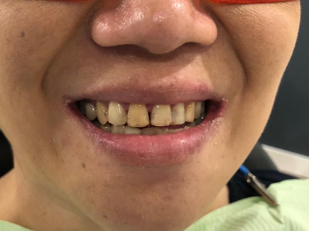 Lyn's Smile Transformation: From Shy to Radiant - White Density