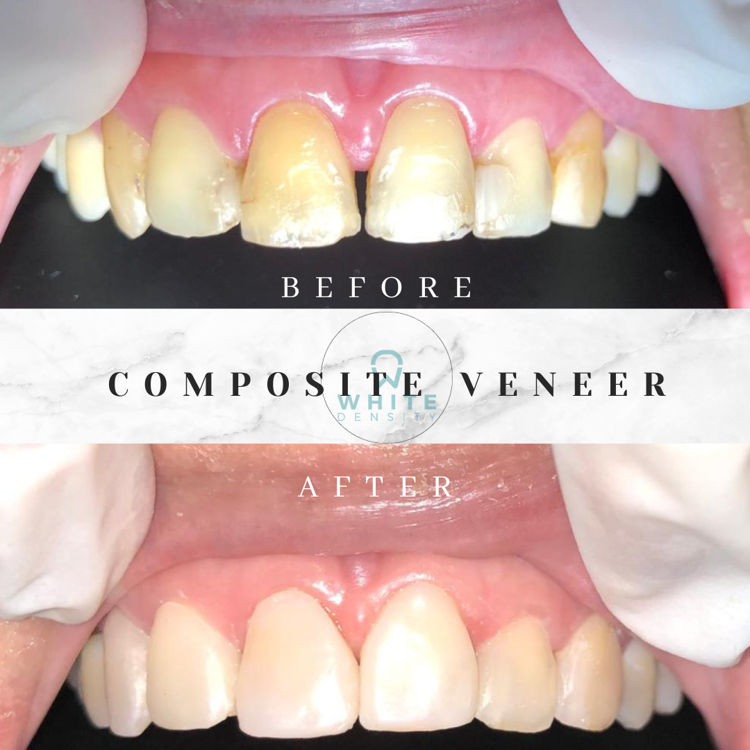 Lyn's Smile Transformation: From Shy to Radiant - White Density