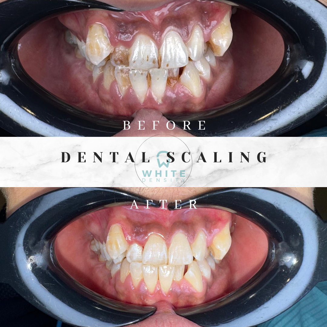 What is Scaling and Polishing - White Density