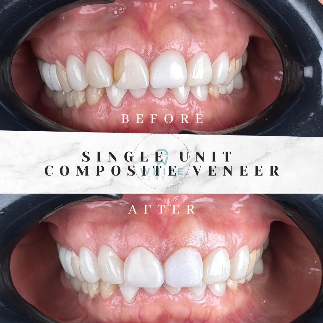 A New Smile Made Simple: How We Helped Fix Chipped Porcelain Veneers ...