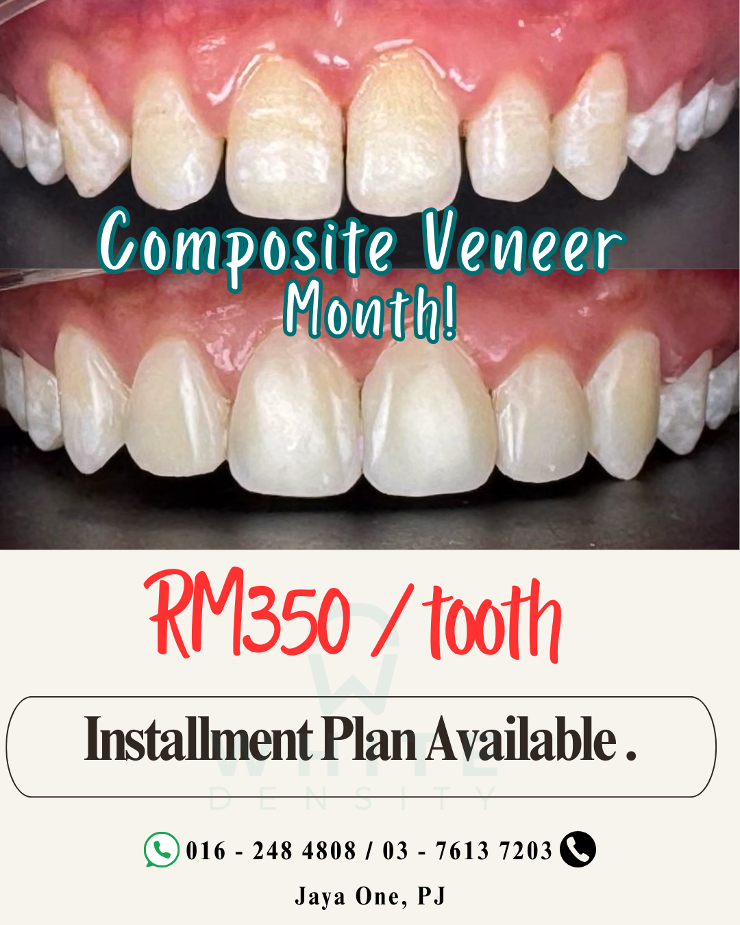 Get the Smile You Deserve – Composite Veneers at RM350 per Tooth ...