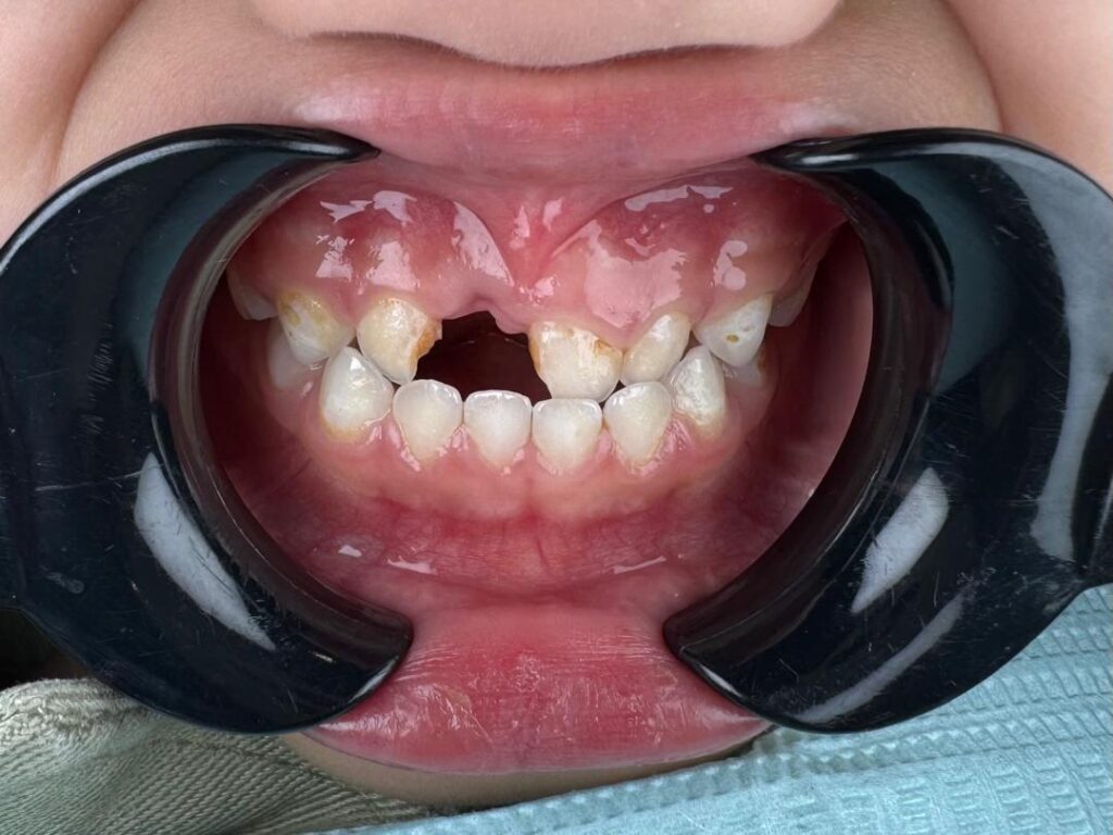 When Accidents Happen: A Brave Little Girl’s Journey After Dental ...