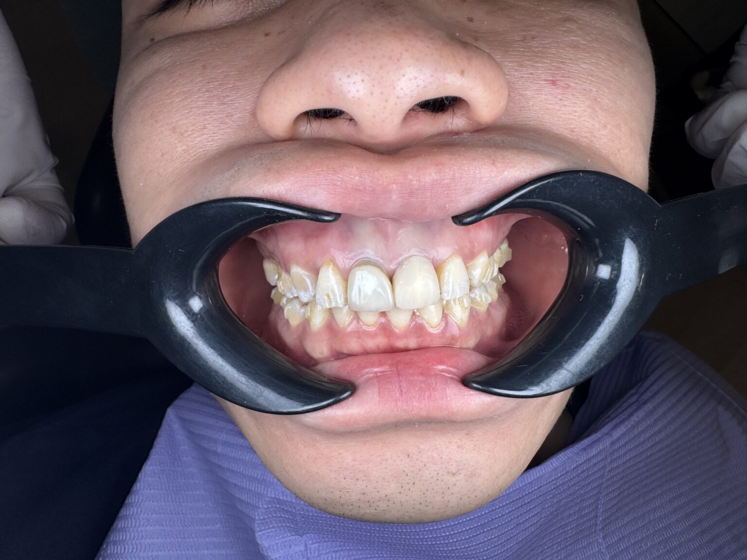 A Case of Fractured Upper Central Incisor - White Density