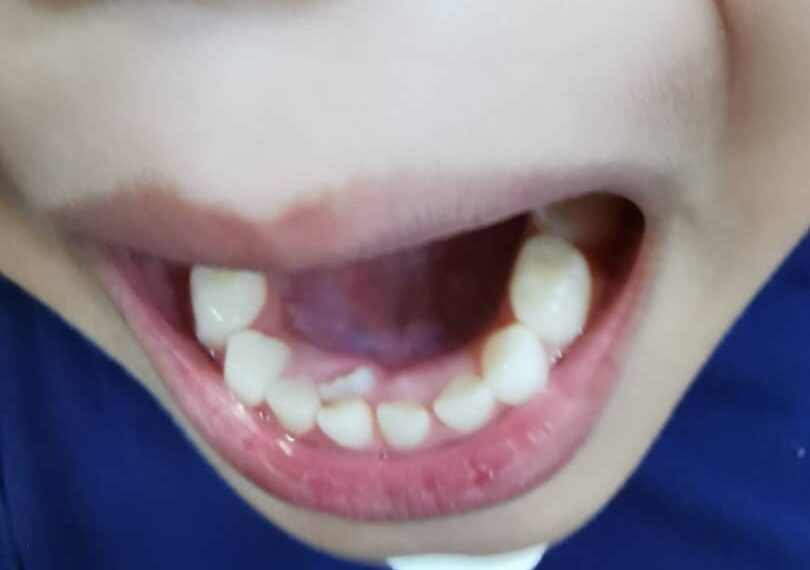 Why Is My Child’s New Tooth Growing Behind the Baby Tooth? A Common ...