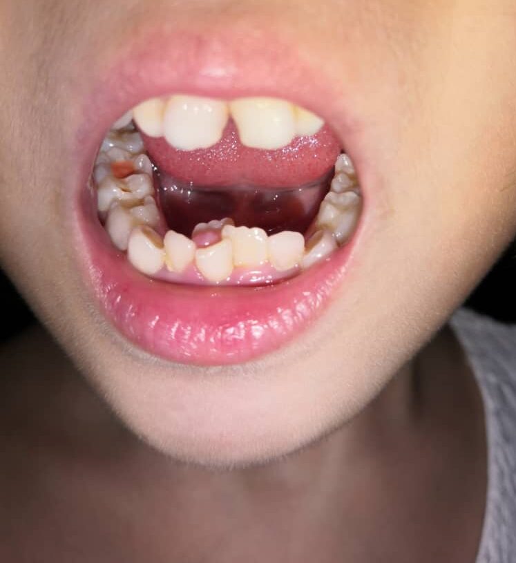 Why Is My Child’s New Tooth Growing Behind the Baby Tooth? A Common ...